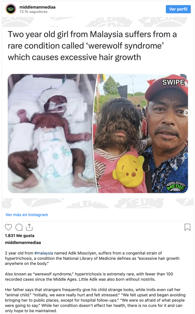 Ella es la ‘niña del cielo’, una pequeña que tiene el síndrome del ...